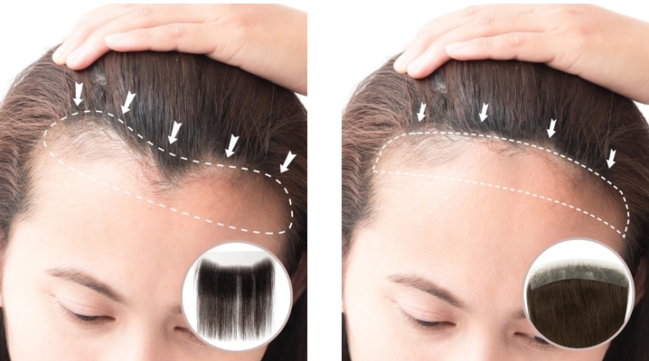 The Art of Lowering Your Hairline with UniWigs Frontal Hair Patch