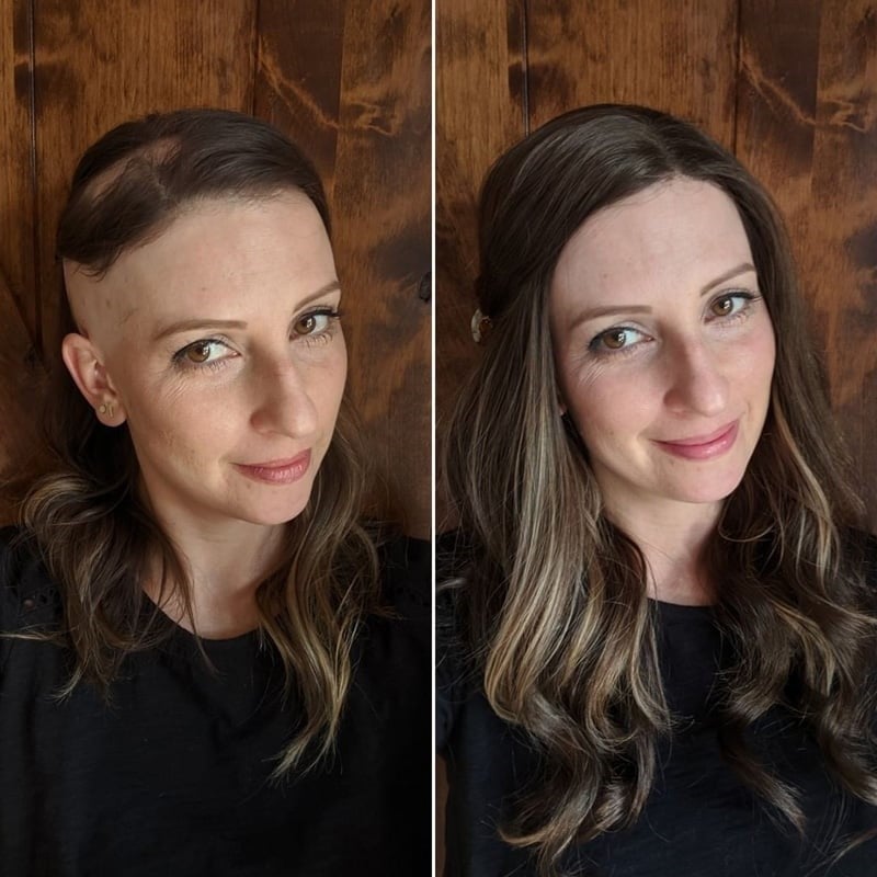 Walks for Alopecia: Making an Impact During Alopecia Awareness Month