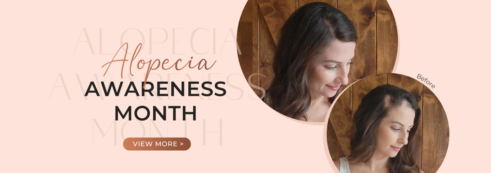 Raising Awareness: Alopecia Awareness Month