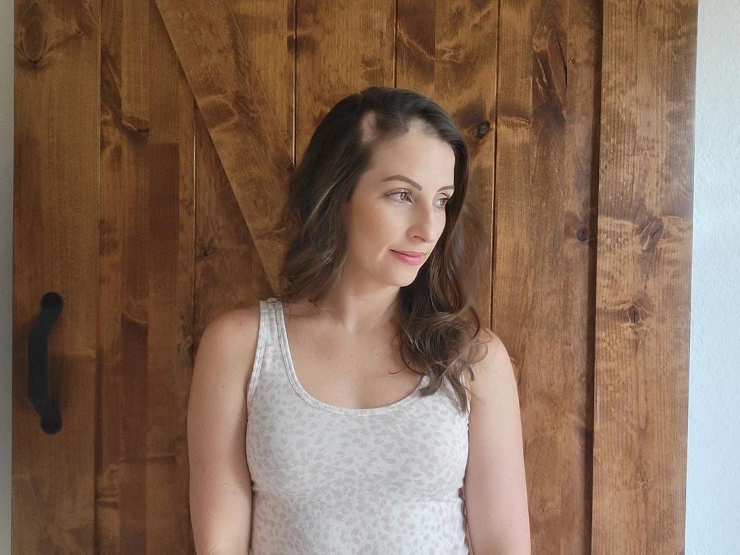 The BEST Cover-up for Alopecia Areata - UniWigs Hair Patches