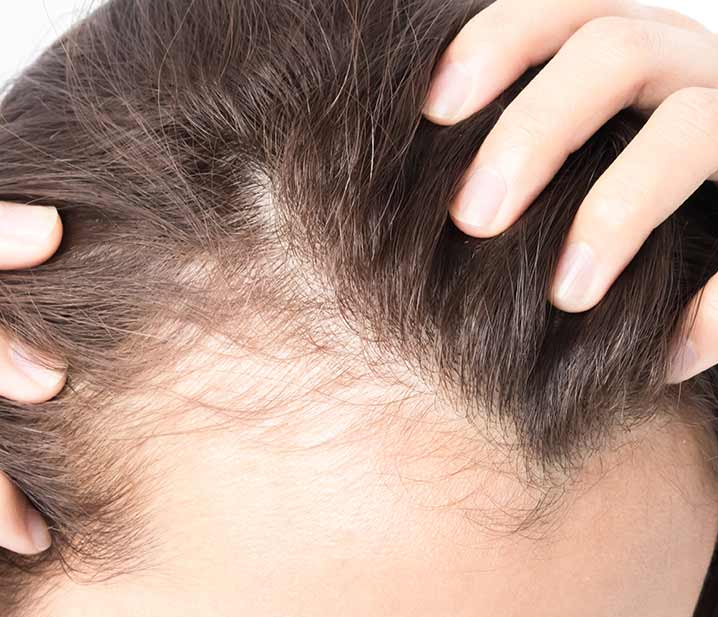 Cover Up Your Bald Spot With A Snap! UniWigs New Hair Patches